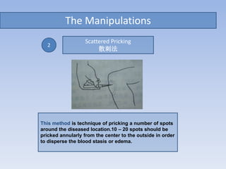 Three edged cutaneous - intradermal needle therapy | PPT