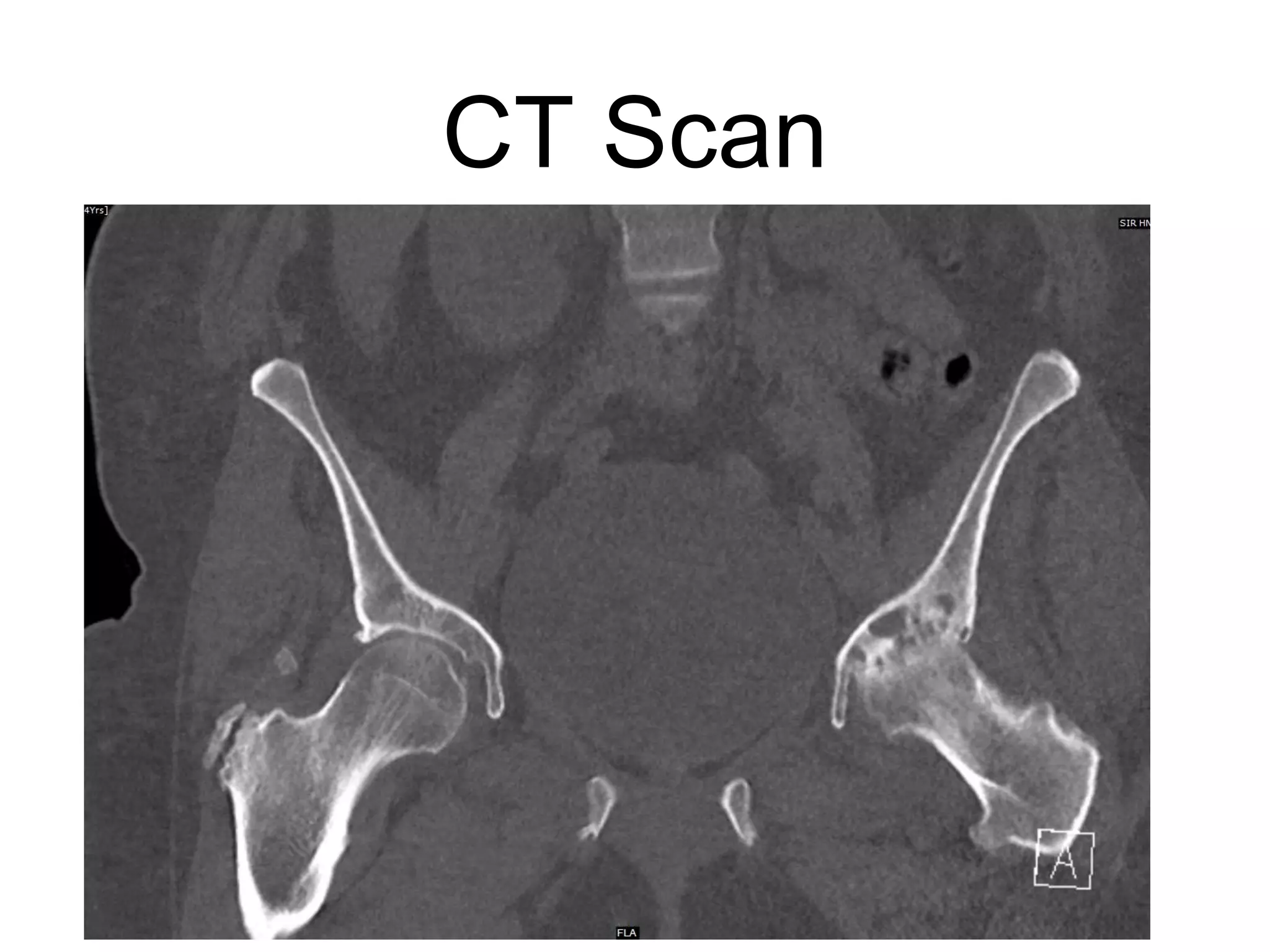 Total Hip replacement for Ankylosing Spondylitis: Planning & Execution ...