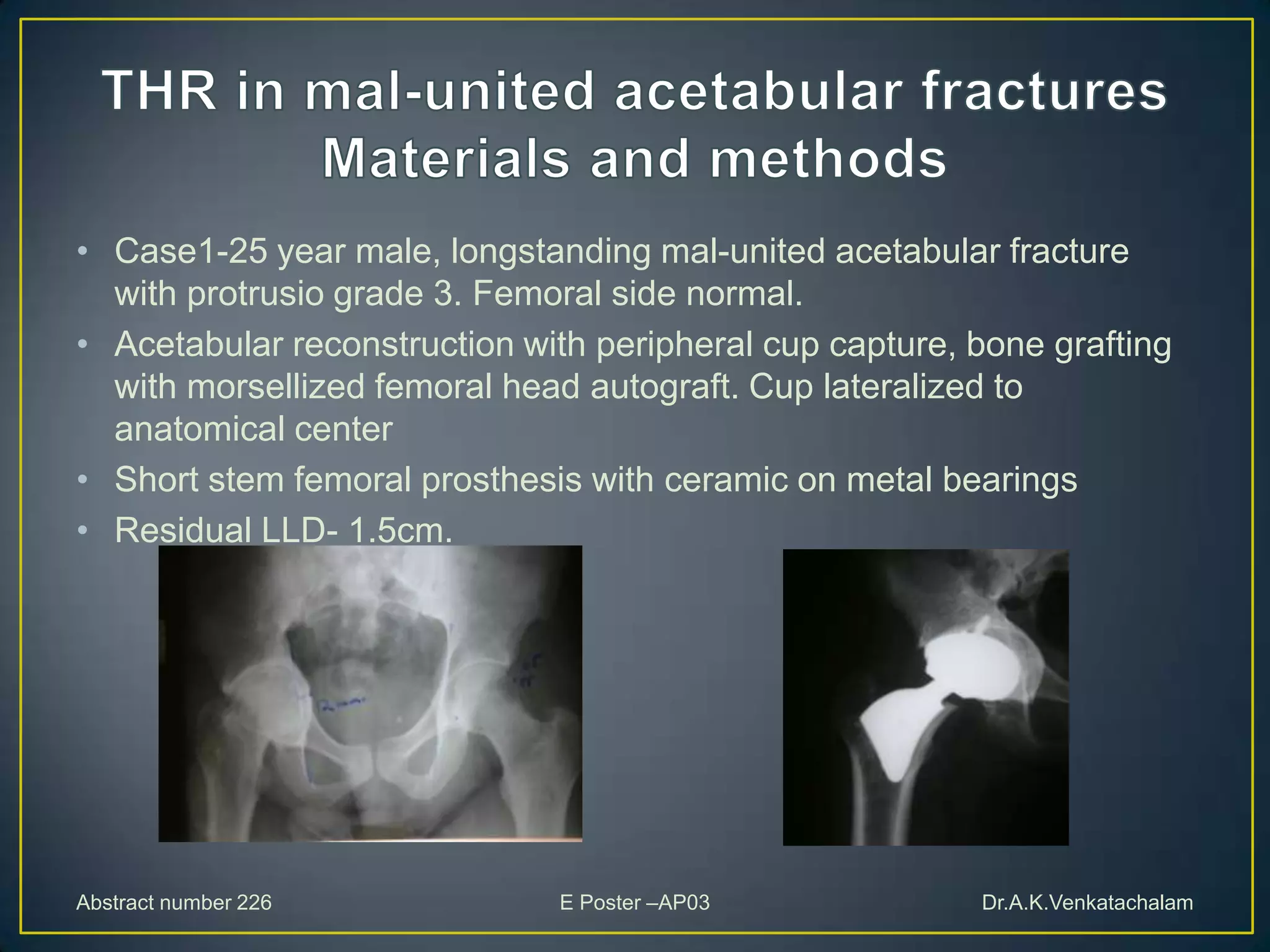 Hip replacement for hip socket fractures- role for short stem hip ...
