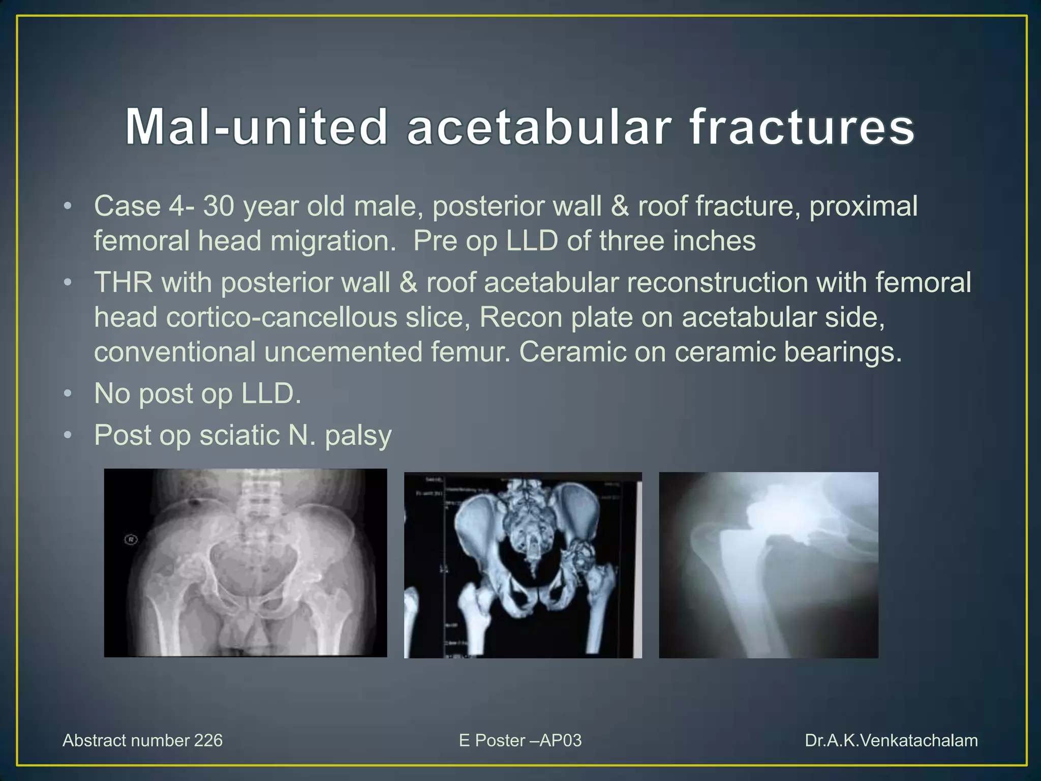 Hip replacement for hip socket fractures- role for short stem hip ...
