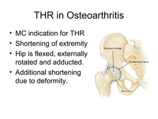 Thr in specific hip disorders | PPT