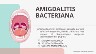 PRINCIPALES AMIGDALITIS BACTERIANAS Y SUS GENERALIDADES | PPTX