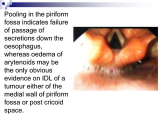 Throat_Pharynx_Carcinoma Hypopharynx_ENT_lectures-2.pptx
