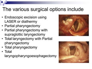 Throat_Pharynx_Carcinoma Hypopharynx_ENT_lectures-2.pptx