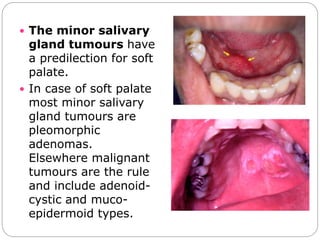 Throat_Pharynx_Carcinoma_Oropharynx_ENT_Lectures.ppt