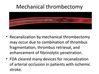 Thrombectomy for ischemic stroke and anaesthesia | PPT