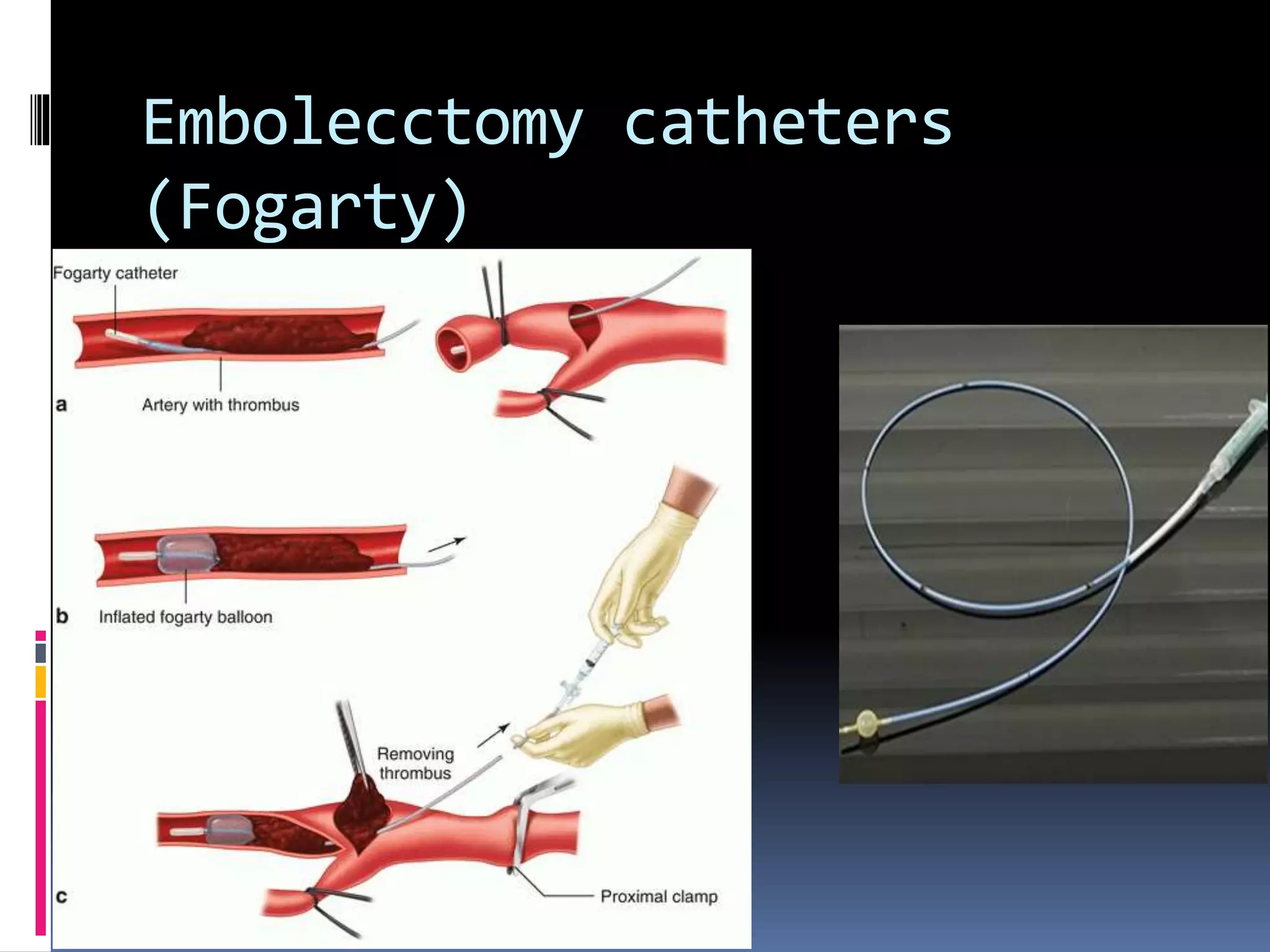 Thrombo embolectomy | PPTX