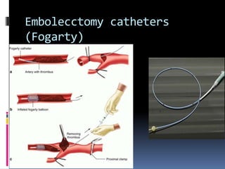 Thrombo embolectomy | PPTX
