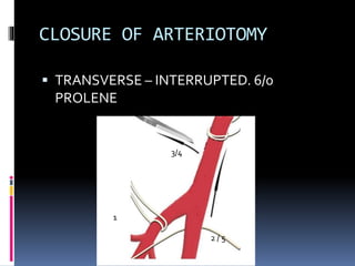 Thrombo embolectomy | PPTX