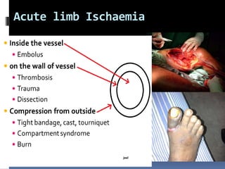 Thrombo embolectomy | PPTX