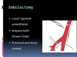 Thrombo embolectomy | PPTX