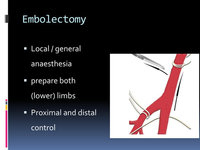 Thrombo embolectomy | PPT