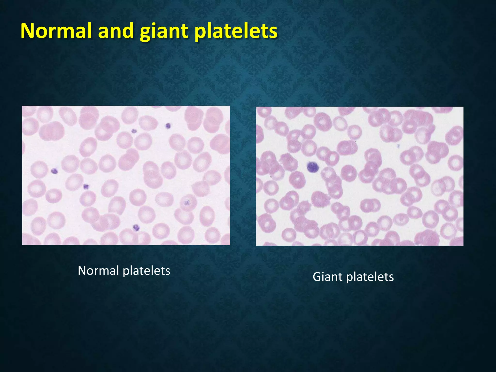 Thrombocytopenia | PPTX