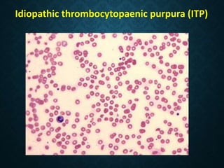 Idiopathic Thrombocytopenic Purpura Smear