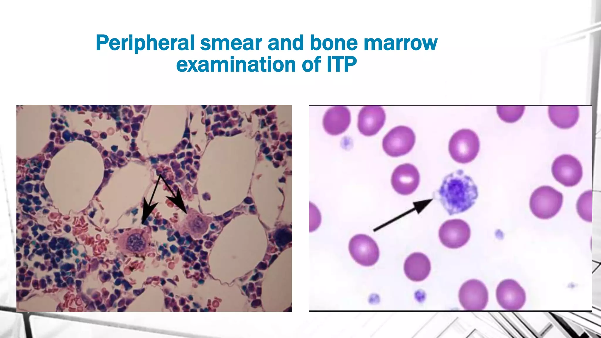 Thrombocytopenia and ITP | PPTX | Blood Disorders | Diseases and Conditions
