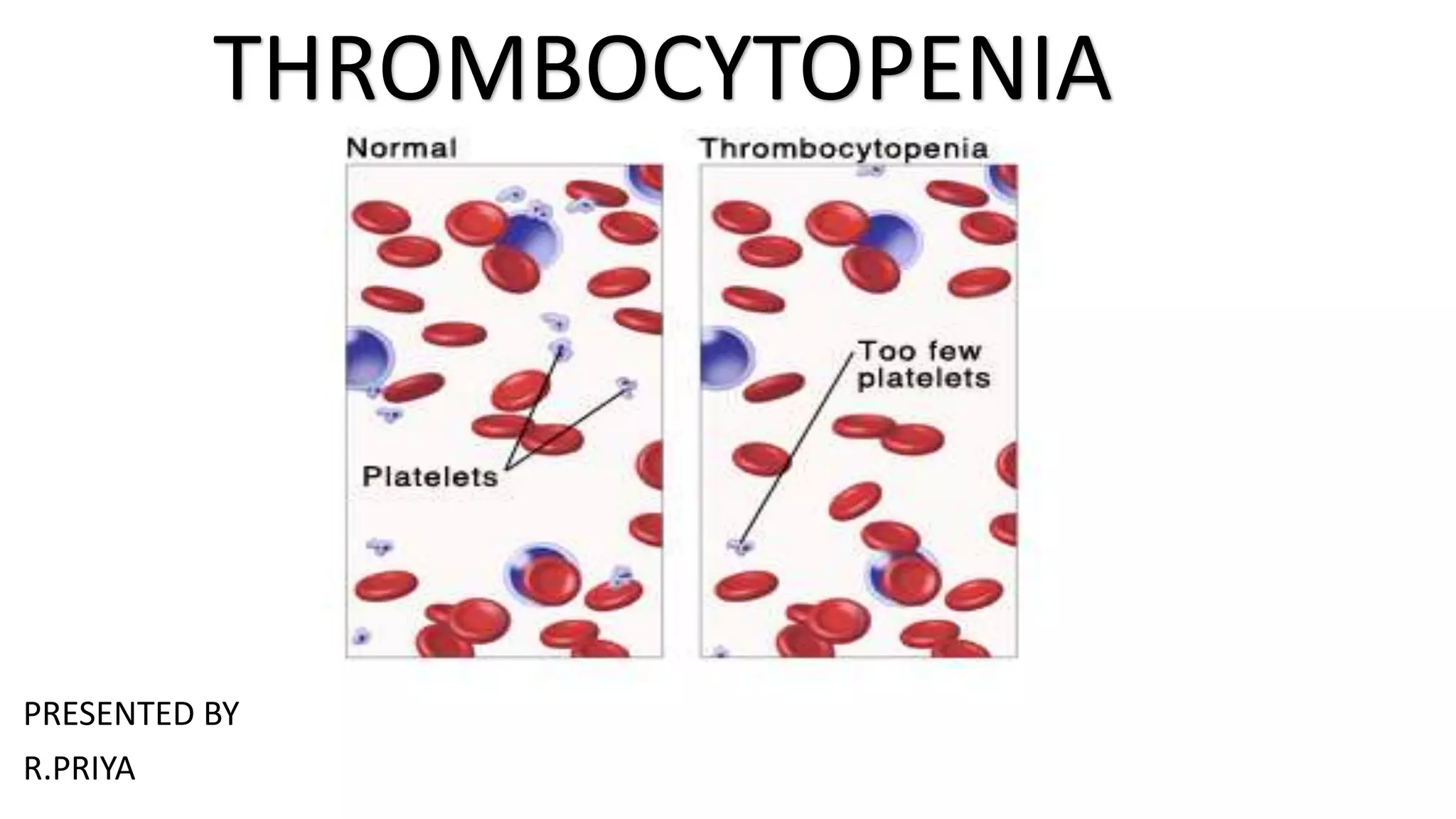 Thrombocytopenia | PPTX
