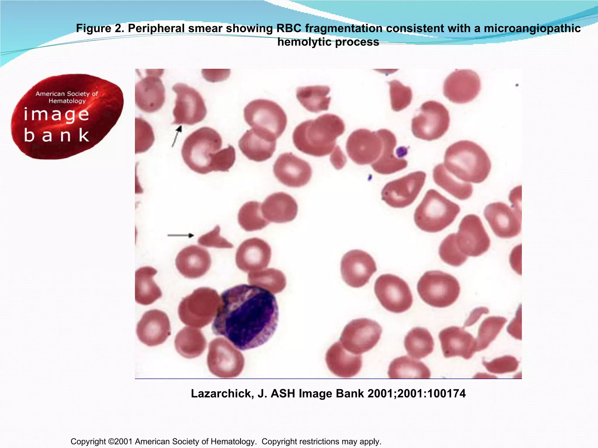 Thrombocytopenia | PPT