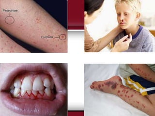 thrombo done1.ppt | Blood Disorders | Diseases and Conditions