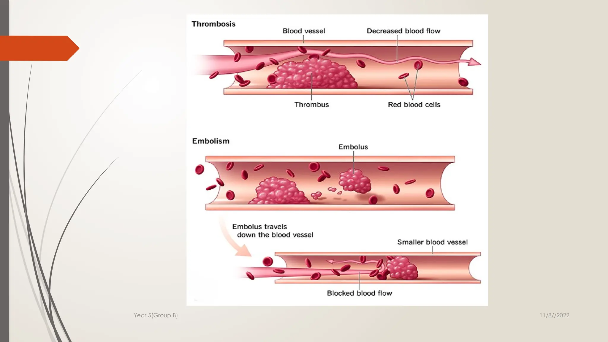 Thromboembolic Disorders (Deep Vein Thrombosis).pptx