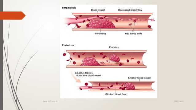 Thromboembolic Disorders (Deep Vein Thrombosis).pptx | Blood Disorders ...