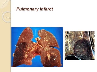 Thromboembolism | PPTX