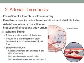 Thromboembolism and Elderly | PPTX