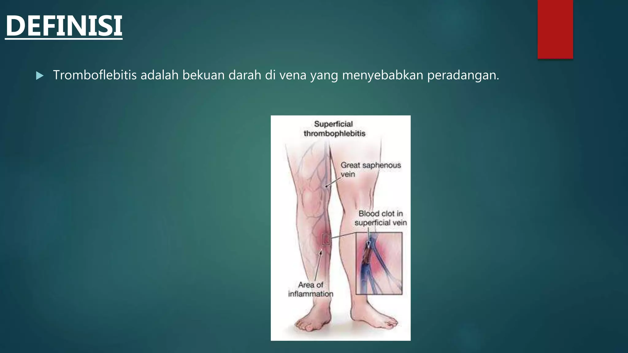 THROMBOPHLEBITIS.pptx