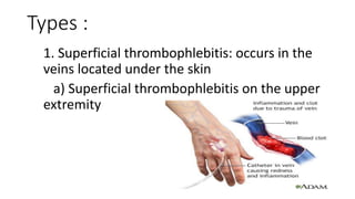 THROMBOPHLEBITIS.pptx