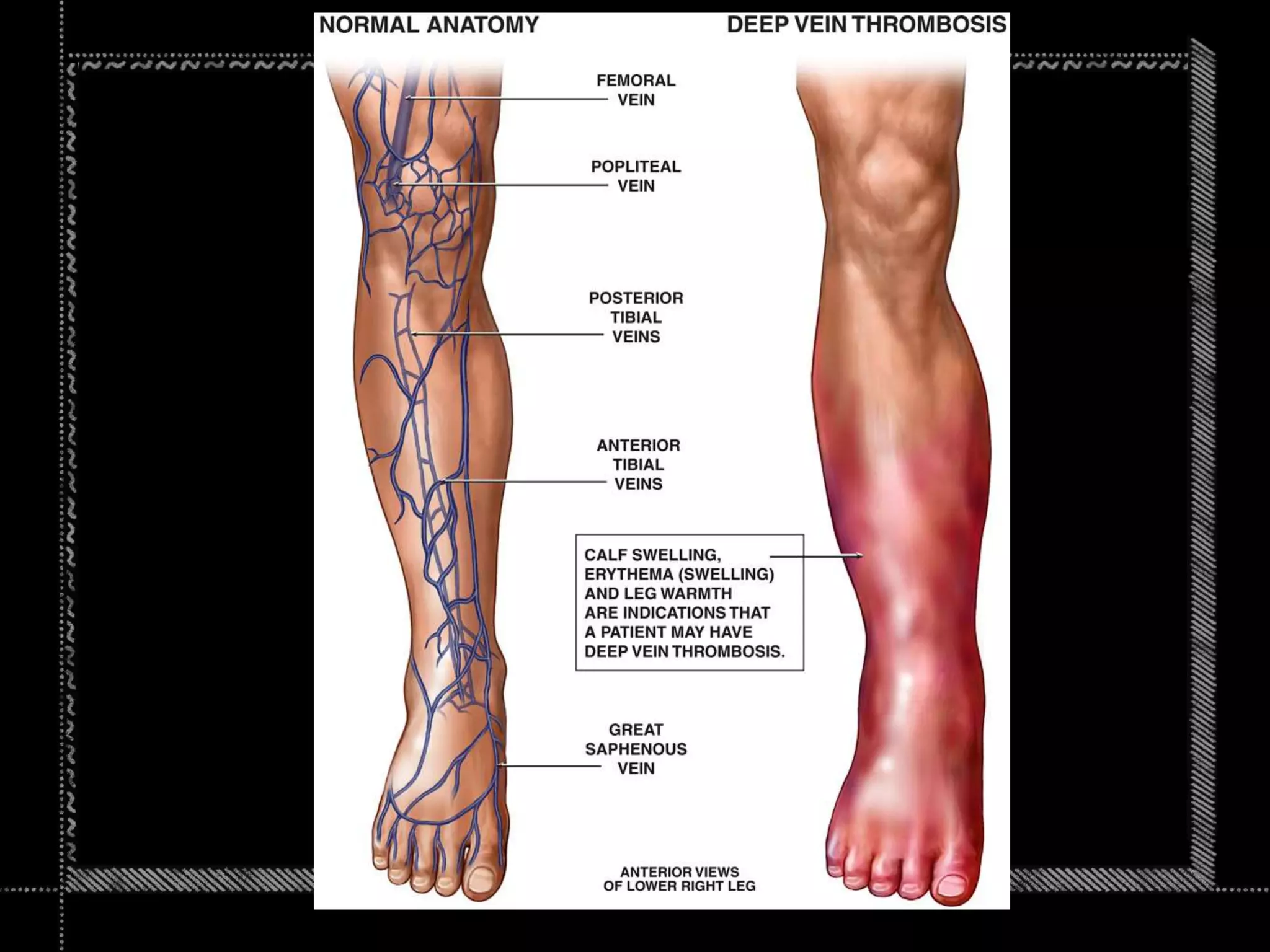 Thrombophlebitis and DVT ppt | PPTX