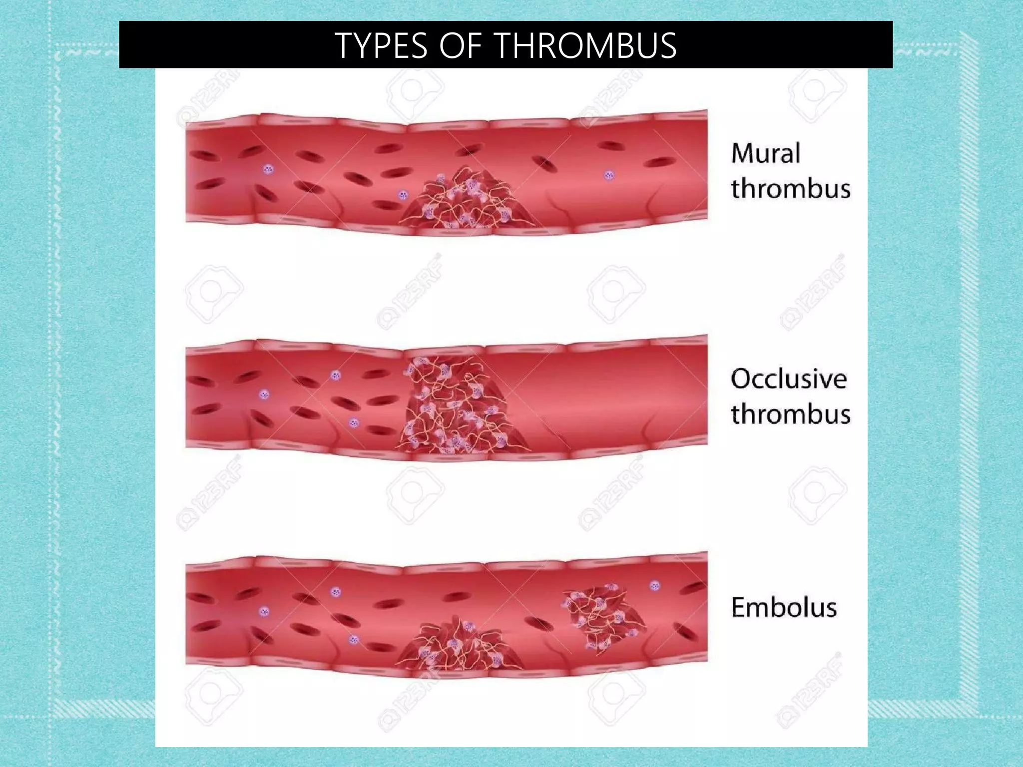 Thrombophlebitis and DVT ppt | PPTX