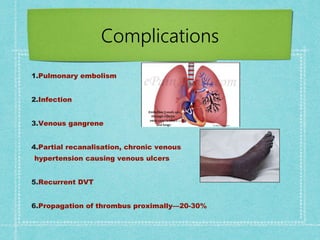 Thrombophlebitis and DVT ppt | PPTX