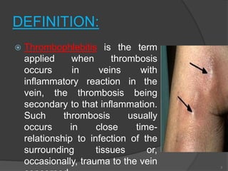 thrombophlebitis and phlebothrombosis.pptx