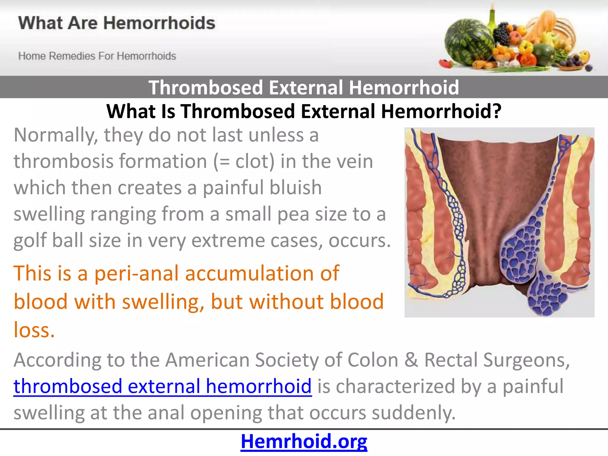 Thrombosed External Hemorrhoid | PPTX