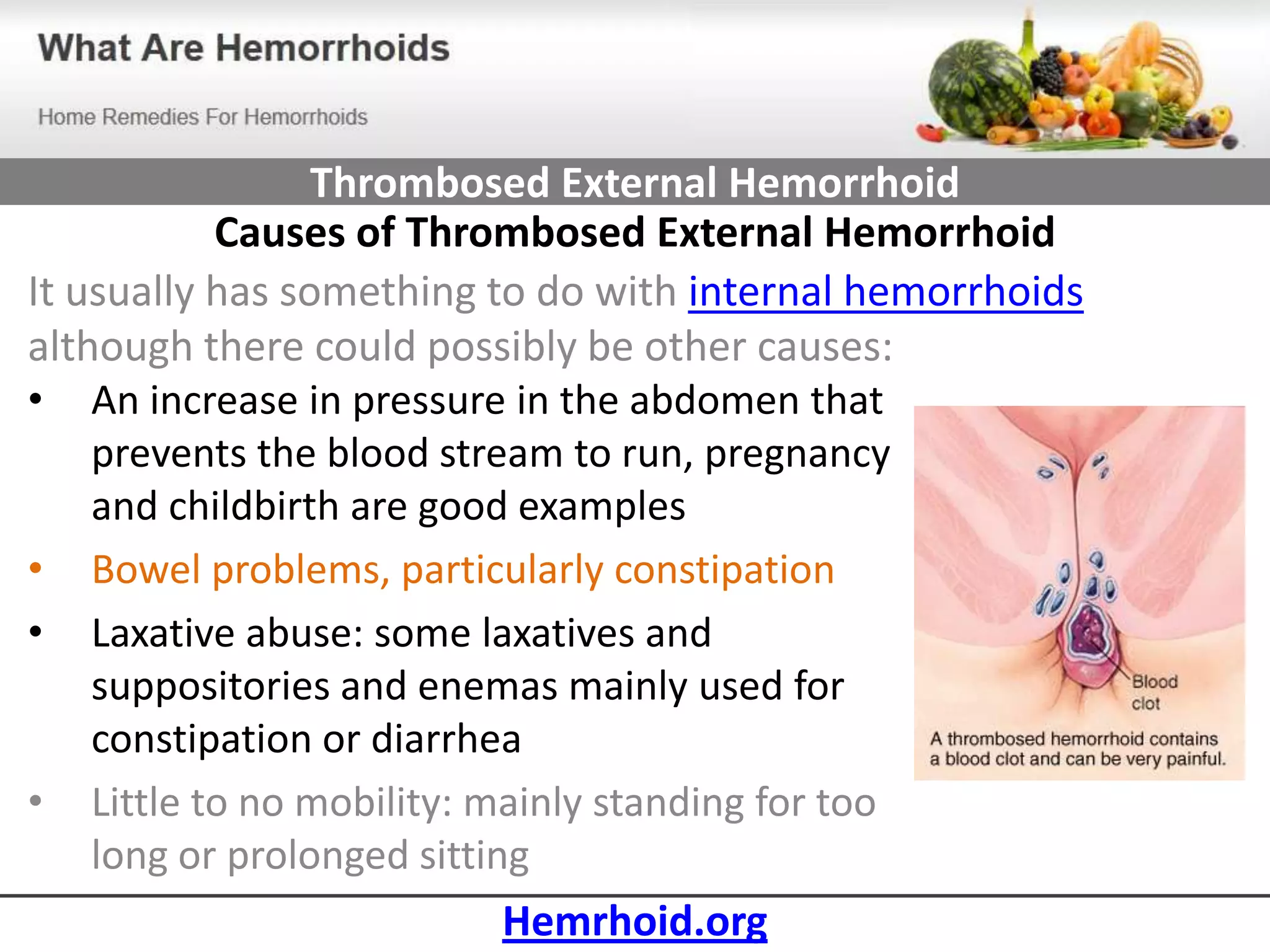 Thrombosed External Hemorrhoid | PPTX