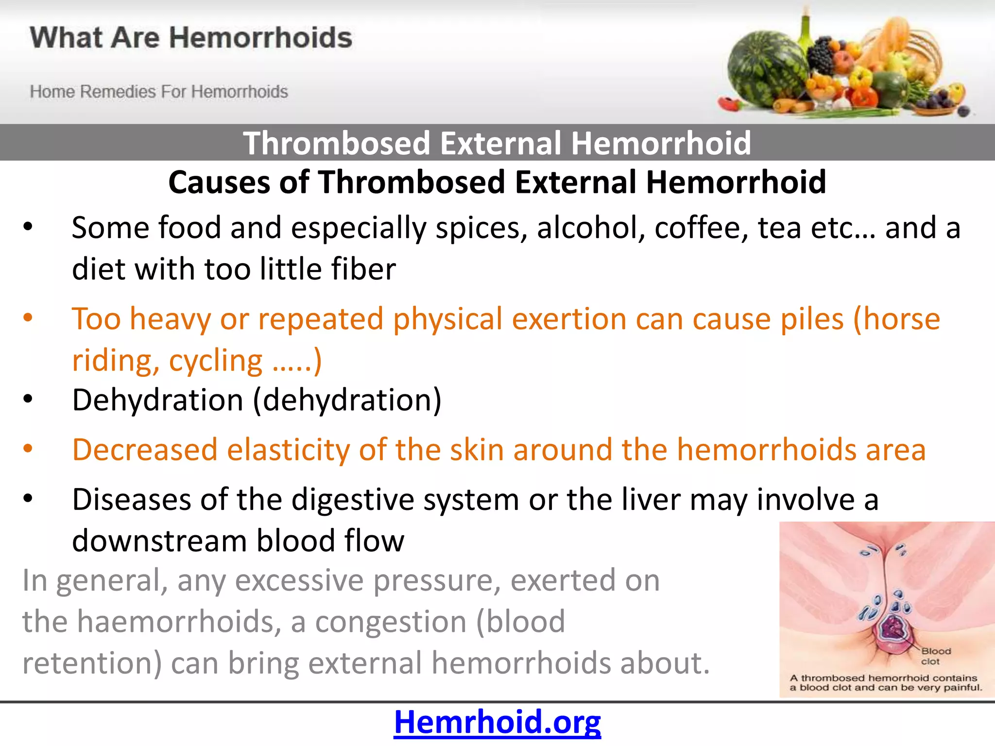 Thrombosed External Hemorrhoid | PPTX