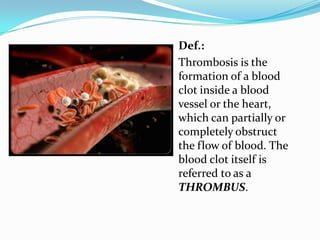 Thrombosis | PPT