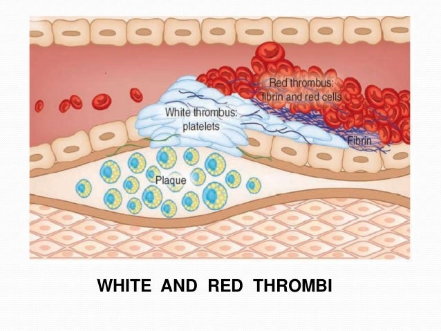 Thrombosis