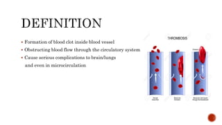 Thrombosis | PPTX