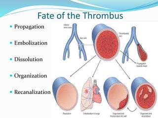 Thrombosis | PPTX