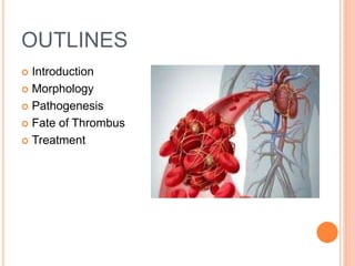 Thrombosis | PPTX