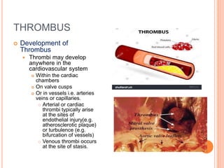 Thrombosis | PPTX