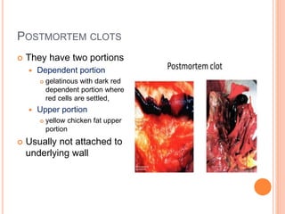 Thrombosis | PPT