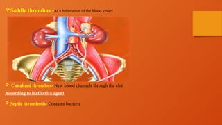 THROMBOSIS ..pptx