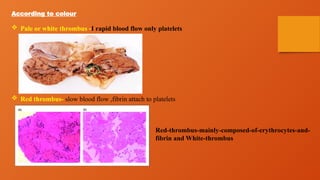 THROMBOSIS ..pptx