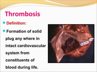 Thrombosis- Dr. Shubhangi V. Agale | PPT