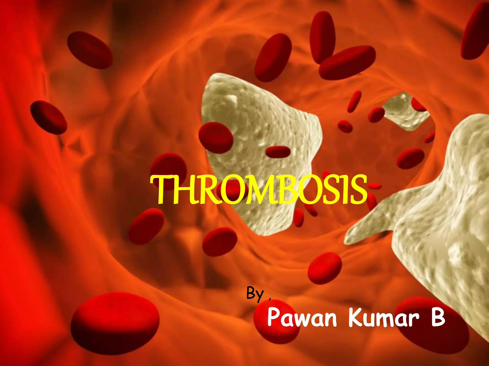Thrombosis - Pathology by Dr.Pawan | PPTX