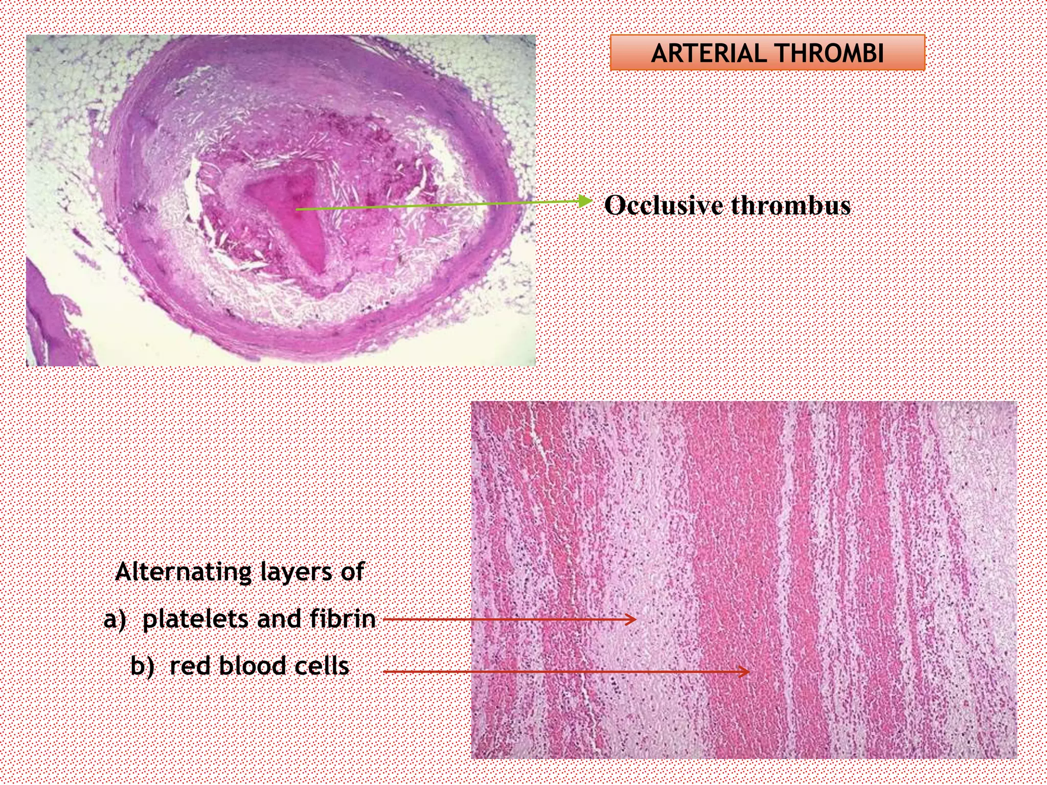 Thrombosis - Pathology by Dr.Pawan | PPTX