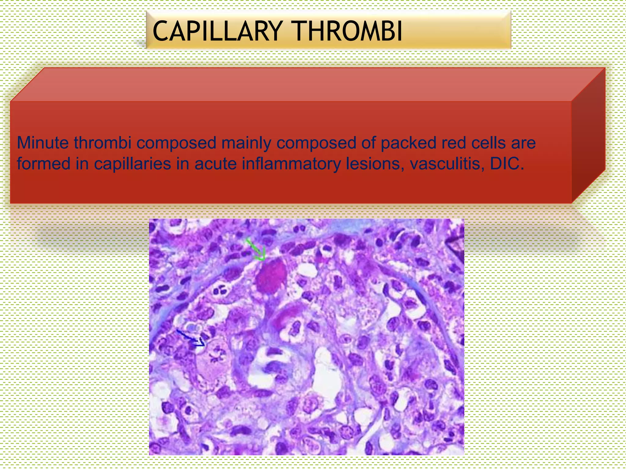 Thrombosis - Pathology by Dr.Pawan | PPTX