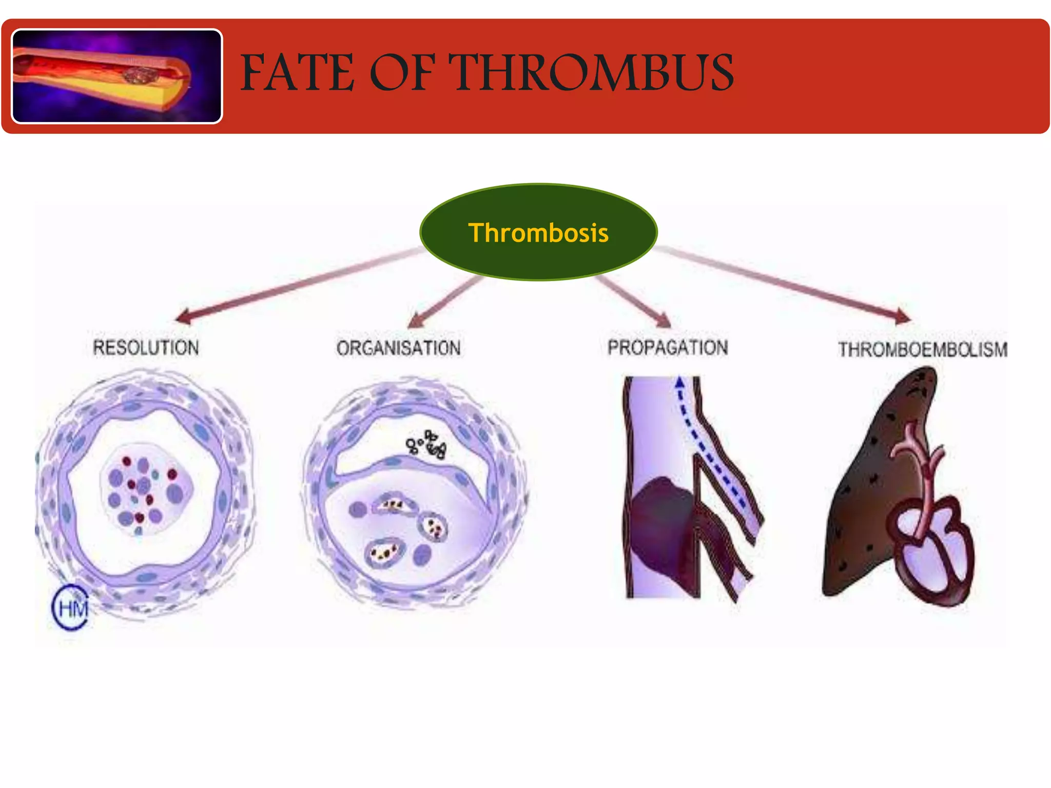 Thrombosis - Pathology by Dr.Pawan | PPTX