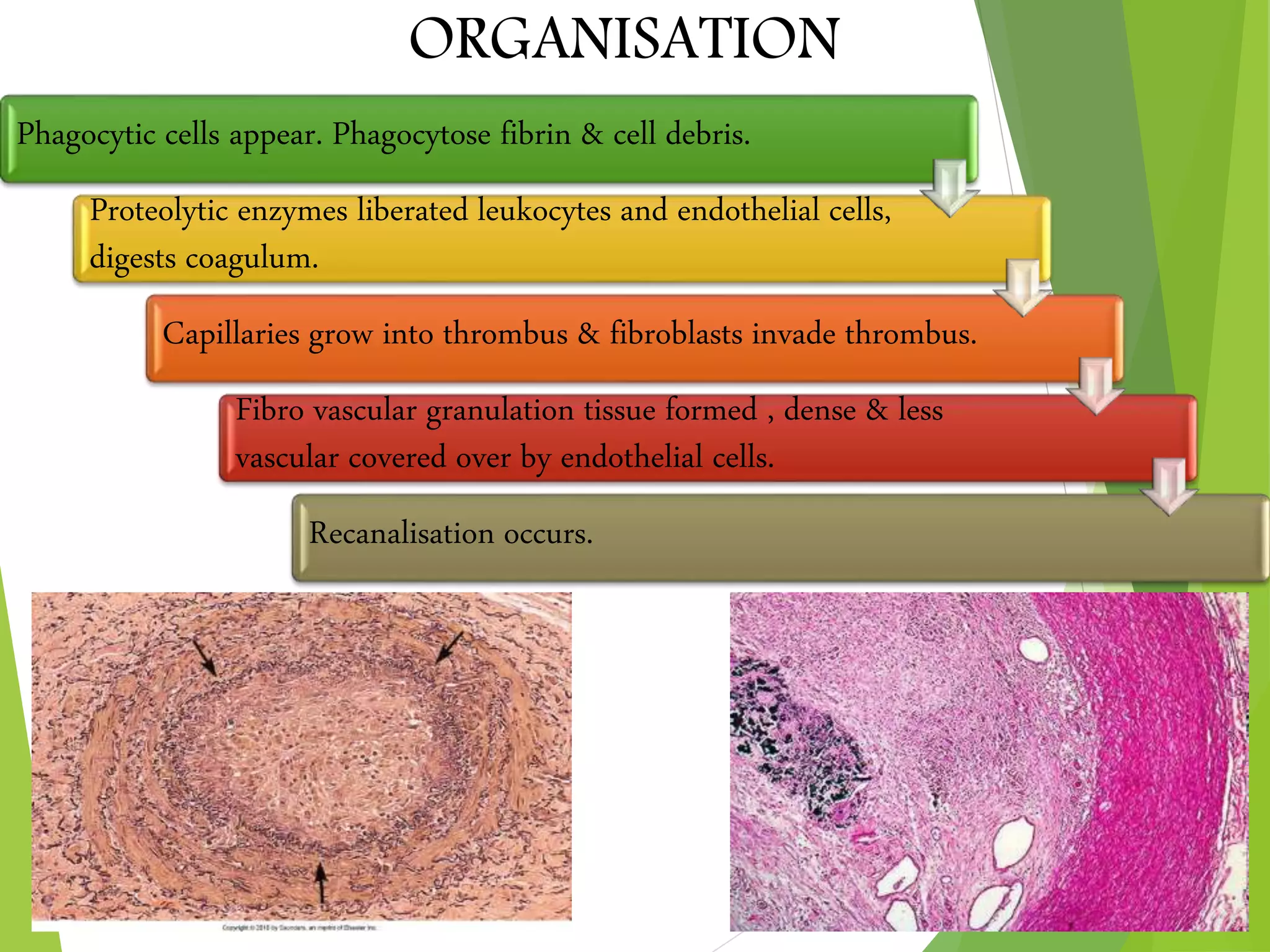Thrombosis - Pathology by Dr.Pawan | PPTX